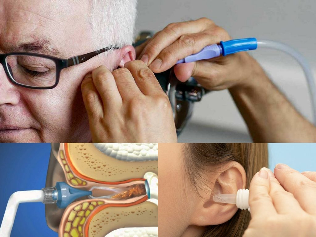 Ear Wax Removal for Tinnitus Treatment - Best Tinnitus Treatment NYC
